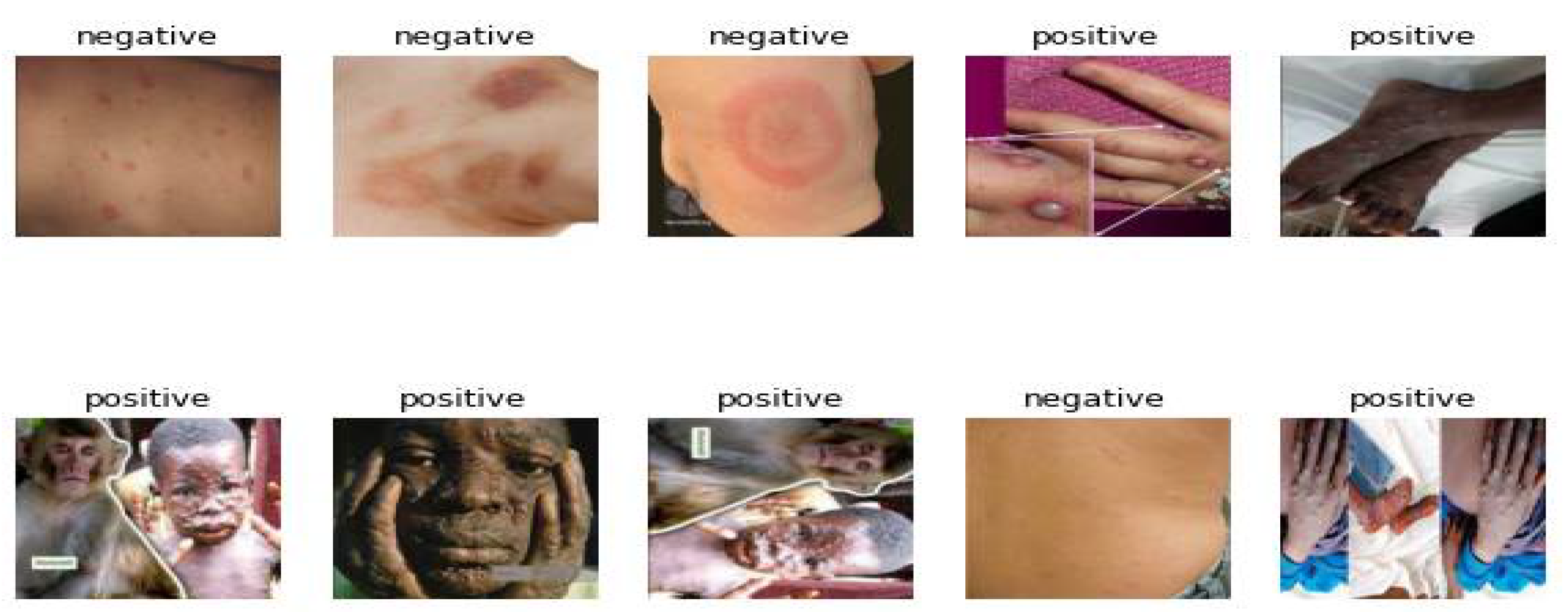 Monkeypox Detection Using CNN with Transfer Learning