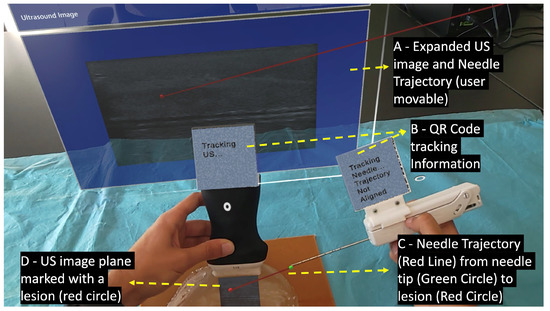 Augmented Reality-Assisted Ultrasound Breast Biopsy