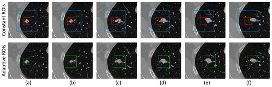 DEHA-Net: A Dual-Encoder-Based Hard Attention Network with an Adaptive ROI Mechanism for Lung ...