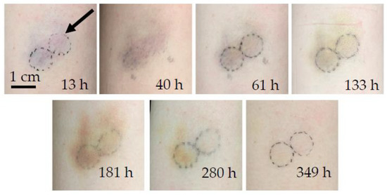 Sensors | Free Full-Text | Pulsed Photothermal Radiometric Depth ...