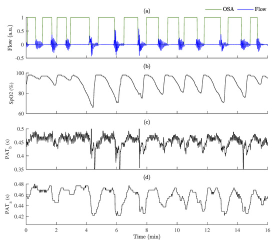 Influence of Photoplethysmogram Signal Quality on Pulse Arrival Time ...