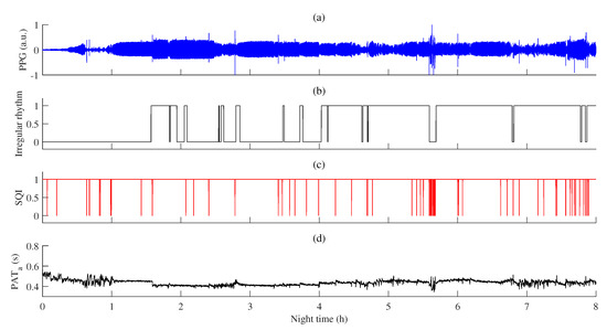 Influence of Photoplethysmogram Signal Quality on Pulse Arrival Time ...