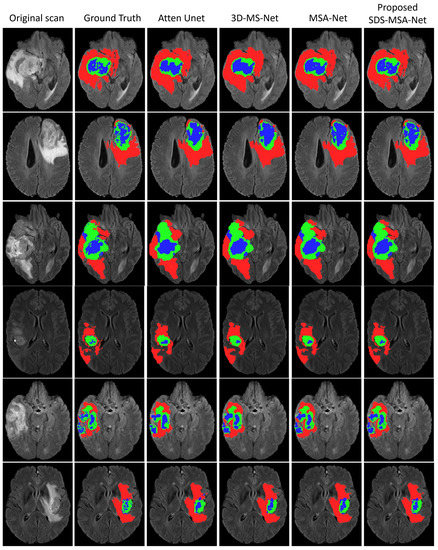 Selective Deeply Supervised Multi-Scale Attention Network for Brain Tumor Segmentation