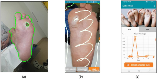 Self-Monitoring Diabetes-Related Foot Ulcers with the MyFootCare App: A ...