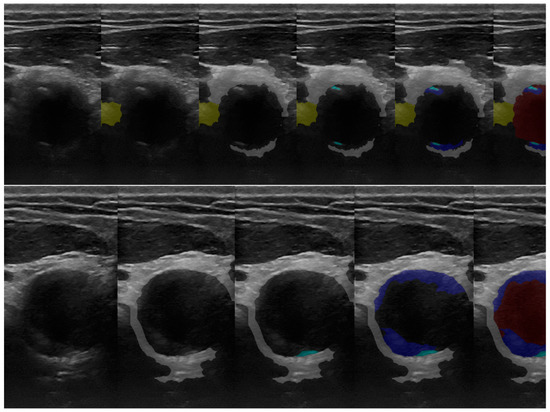 3D Ultrasound Reconstructions of the Carotid Artery and Thyroid Gland Using Artificial ...