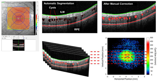 A Review of Machine Learning Algorithms for Retinal Cyst Segmentation ...