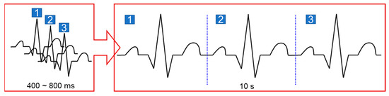 An ECG Stitching Scheme for Driver Arrhythmia Classification Based on ...