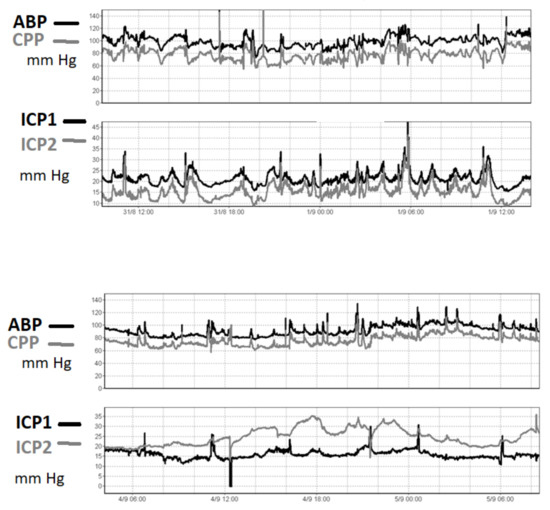 Accuracy of Intracranial Pressure Monitoring—Single Centre ...