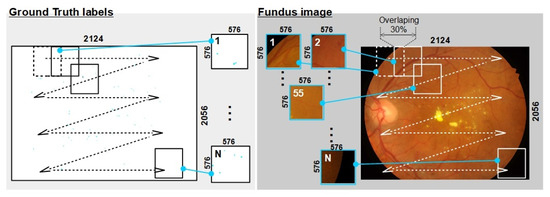 Automatic Detection of Microaneurysms in Fundus Images Using an Ensemble-Based Segmentation Method