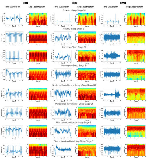 Simultaneous Sleep Stage and Sleep Disorder Detection from Multimodal ...