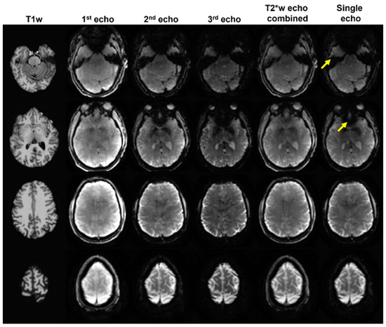 Improved Resting-State Functional MRI Using Multi-Echo Echo-Planar ...