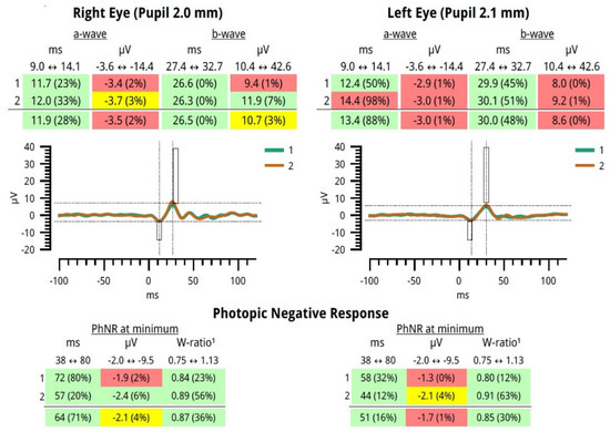 Investigating the Structural and Functional Changes in the Optic Nerve ...