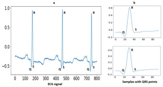 Sensors | Free Full-Text | Hybrid Deep Learning and Discrete Wavelet Transform-Based ECG ...