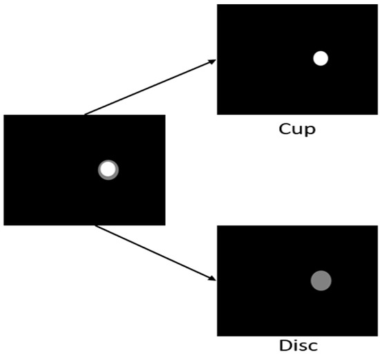 Identifying the Edges of the Optic Cup and the Optic Disc in Glaucoma Patients by Segmentation