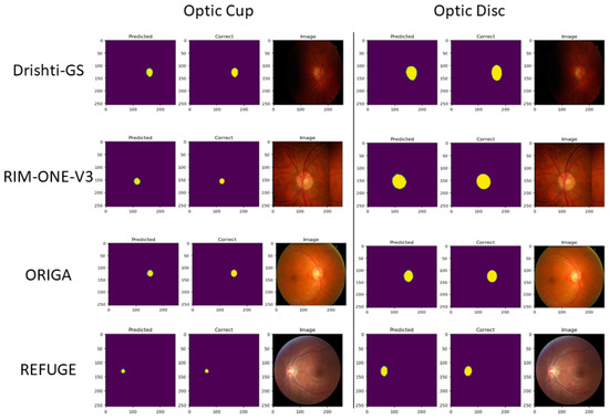Identifying the Edges of the Optic Cup and the Optic Disc in Glaucoma Patients by Segmentation