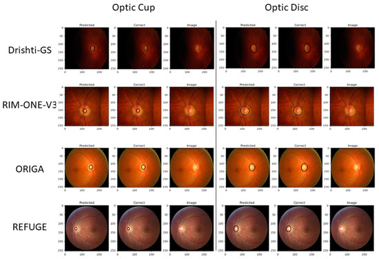 Identifying the Edges of the Optic Cup and the Optic Disc in Glaucoma ...