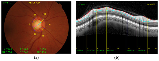 Analysis of the Asymmetry between Both Eyes in Early Diagnosis of ...
