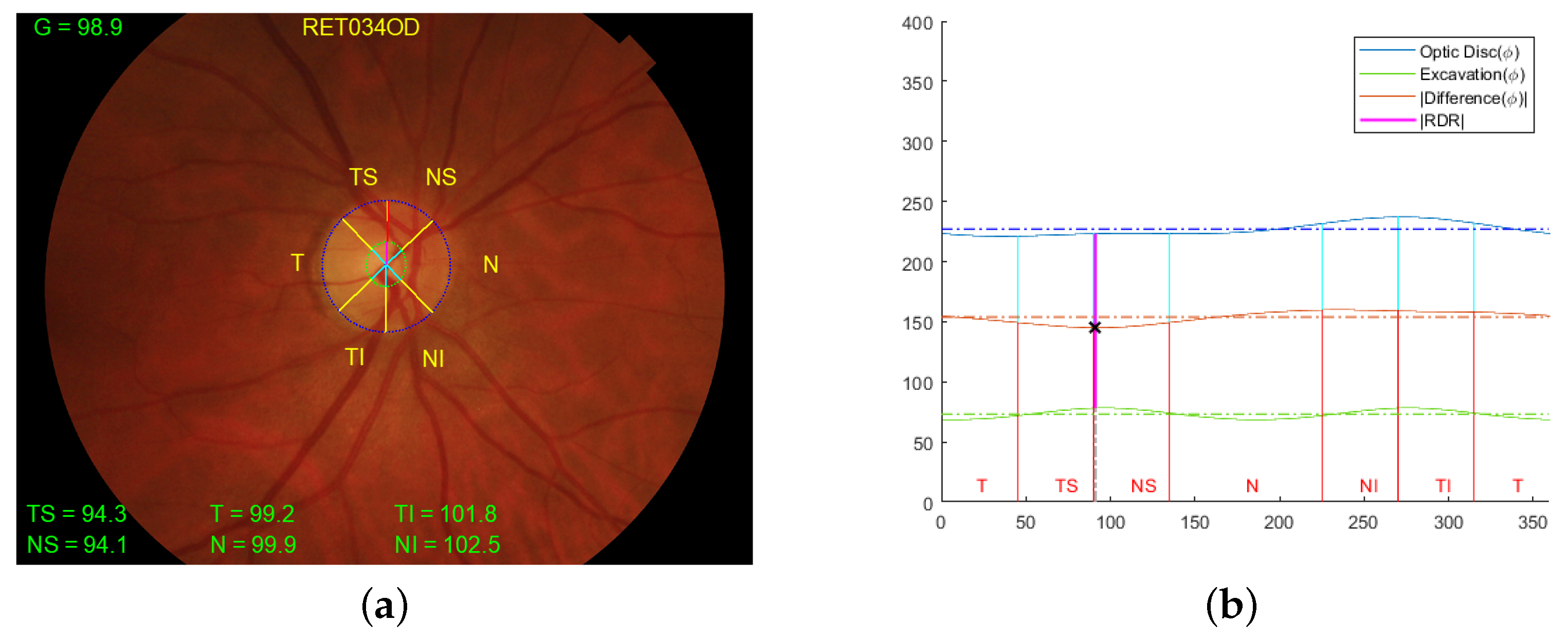 Analysis of the Asymmetry between Both Eyes in Early Diagnosis of ...