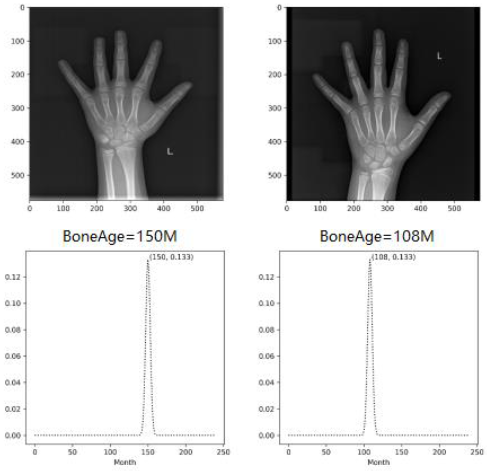 Multi-Branch Attention Learning for Bone Age Assessment with Ambiguous ...