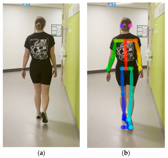 Automated Implementation of the Edinburgh Visual Gait Score (EVGS) Using OpenPose and Handheld ...