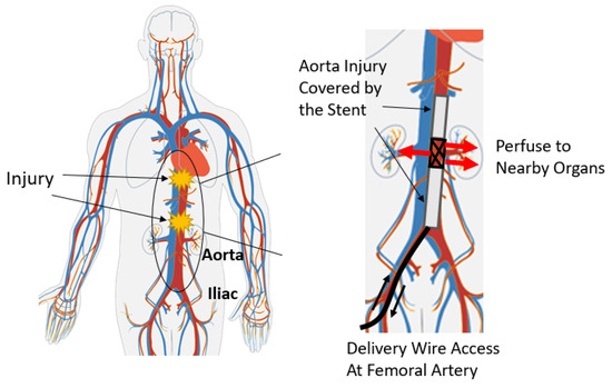 A System to Track Stent Location in the Human Body by Fusing ...