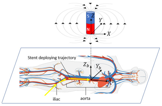 A System to Track Stent Location in the Human Body by Fusing ...