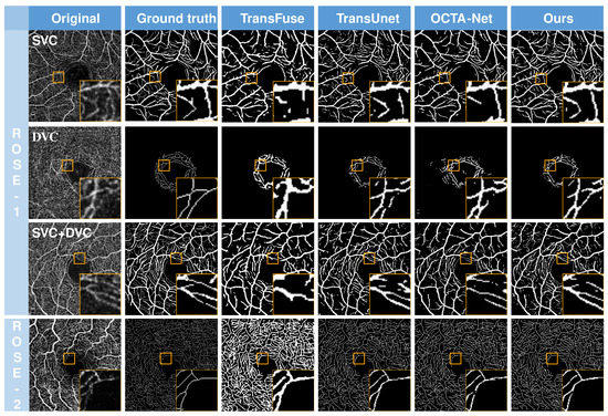 TCU-Net: Transformer Embedded in Convolutional U-Shaped Network for Retinal Vessel Segmentation