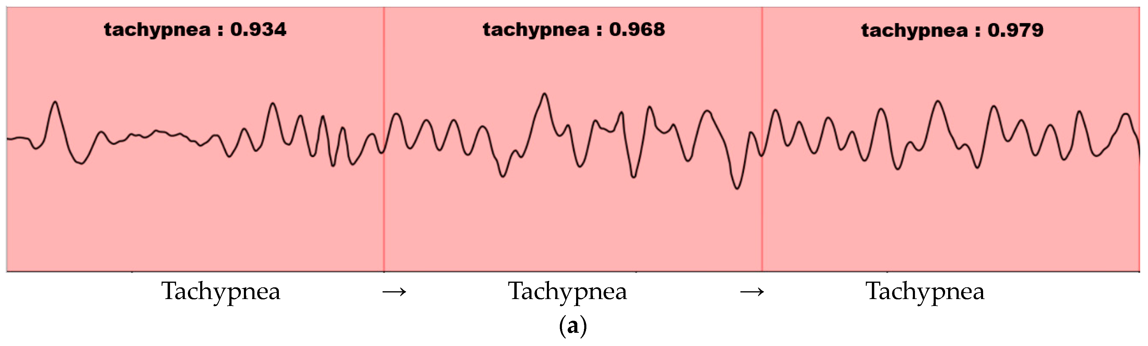 Detection of Multiple Respiration Patterns Based on 1D SNN from ...