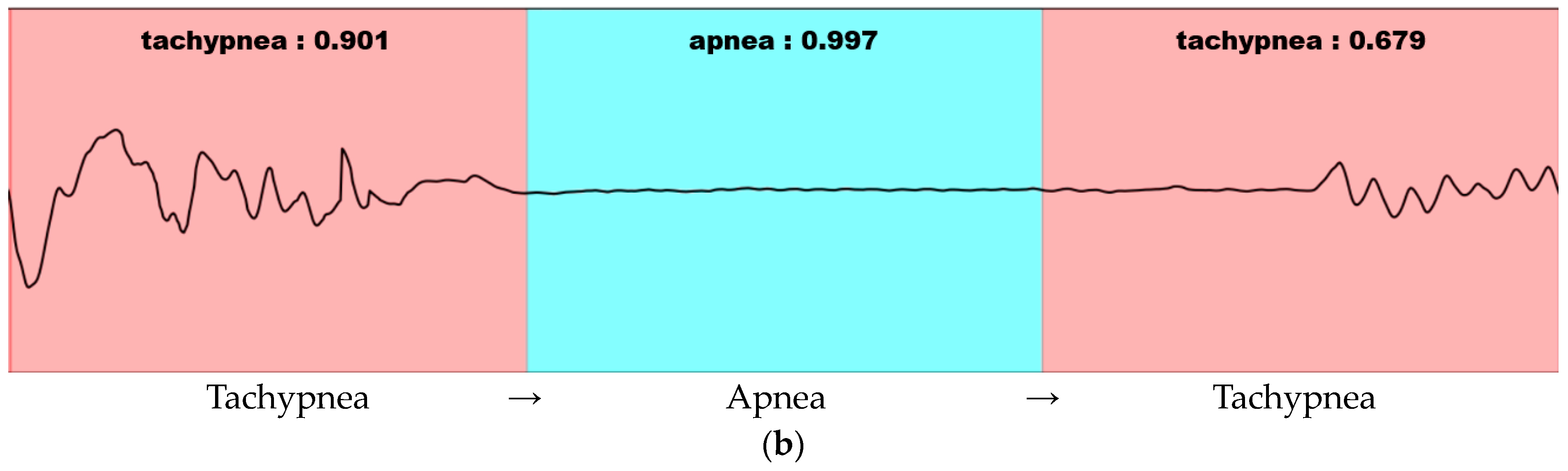 Detection of Multiple Respiration Patterns Based on 1D SNN from ...