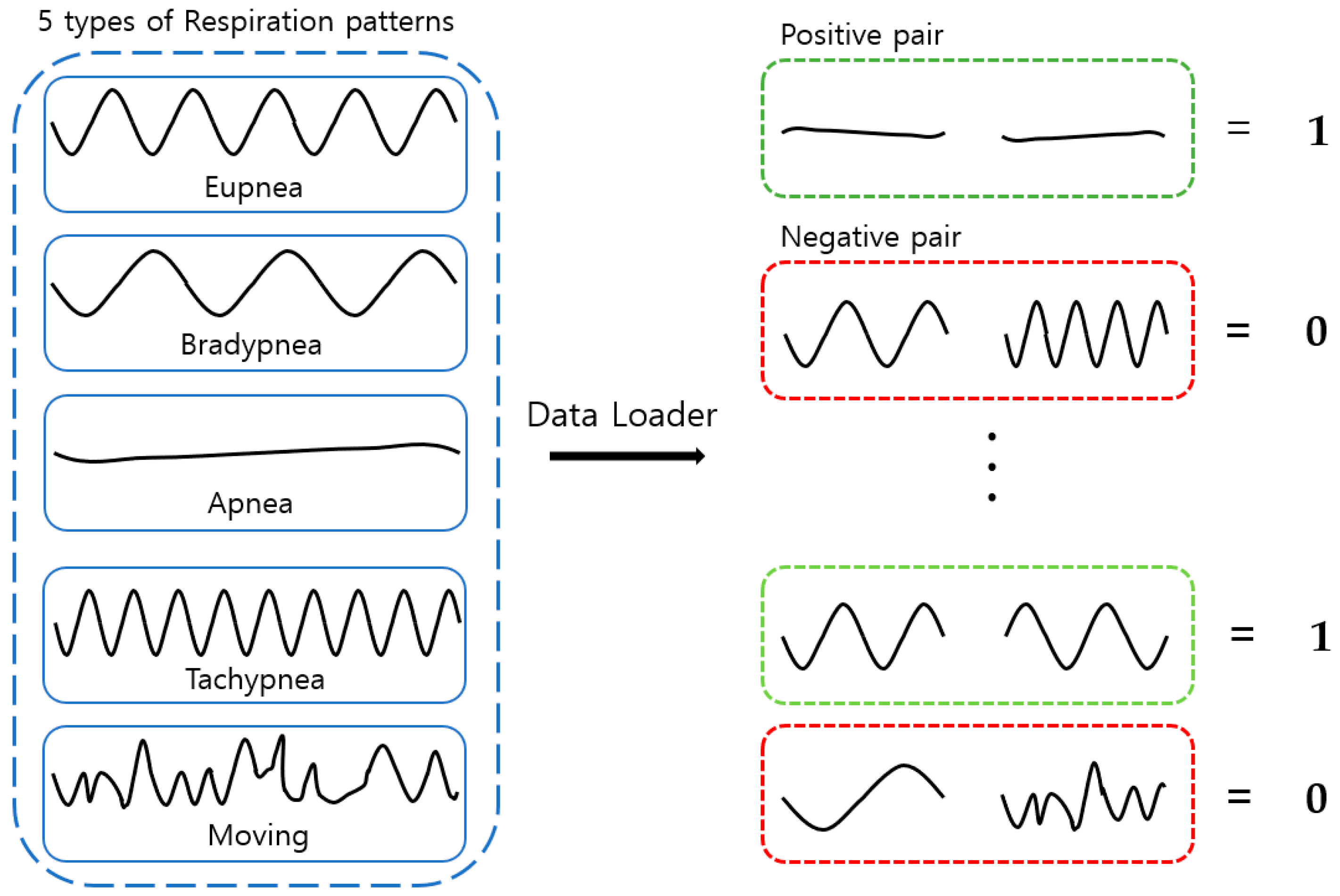 Detection of Multiple Respiration Patterns Based on 1D SNN from Continuous Human Breathing ...