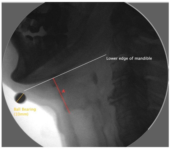 Non-Contact Assessment of Swallowing Dysfunction Using Smartphone ...
