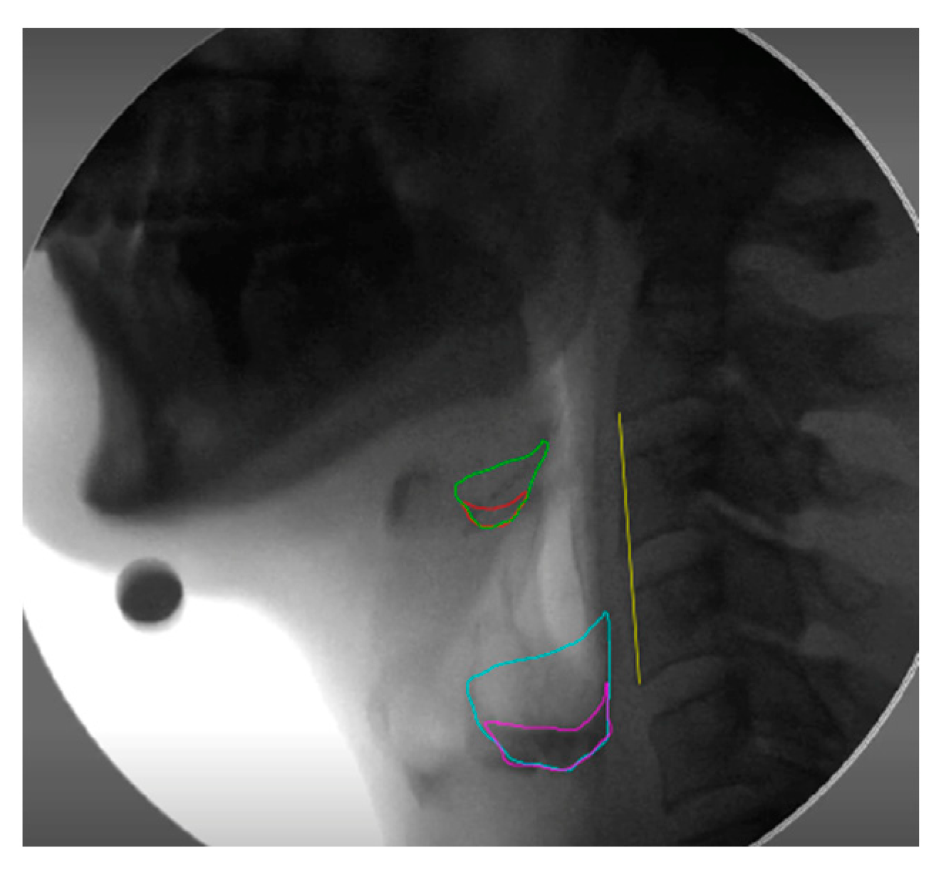 Valleculae And Pyriform Sinuses