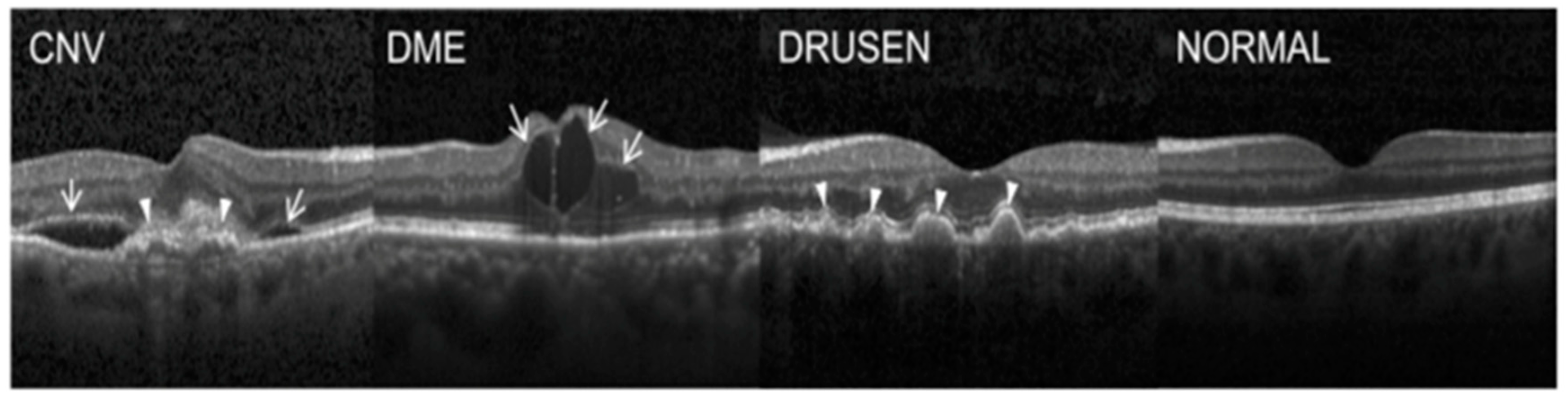 Enhanced Deep Learning Model for Classification of Retinal Optical Coherence Tomography Images