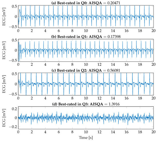 Automated Signal Quality Assessment of Single-Lead ECG Recordings for ...