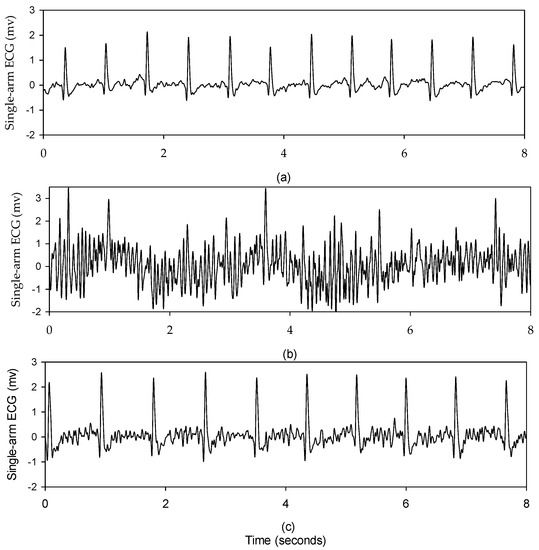 Signal Quality Analysis of Single-Arm Electrocardiography
