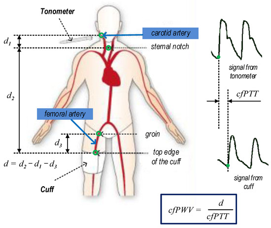 Relationship between the Central and Regional Pulse Wave Velocity in the Assessment of Arterial ...