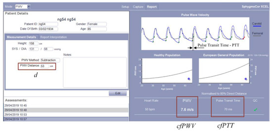 Relationship between the Central and Regional Pulse Wave Velocity in the Assessment of Arterial ...