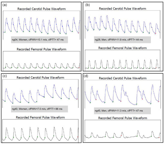 Relationship between the Central and Regional Pulse Wave Velocity in ...