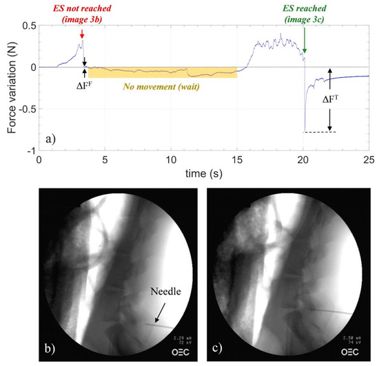 Recent Advances in Smart Epidural Spinal Needles