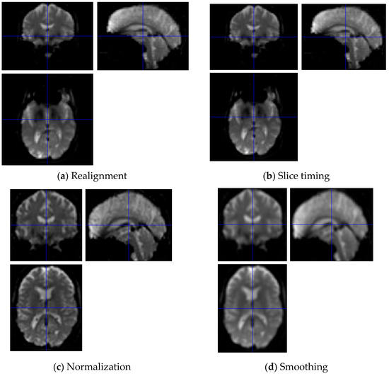 Classification of Alzheimer’s Progression Using fMRI Data
