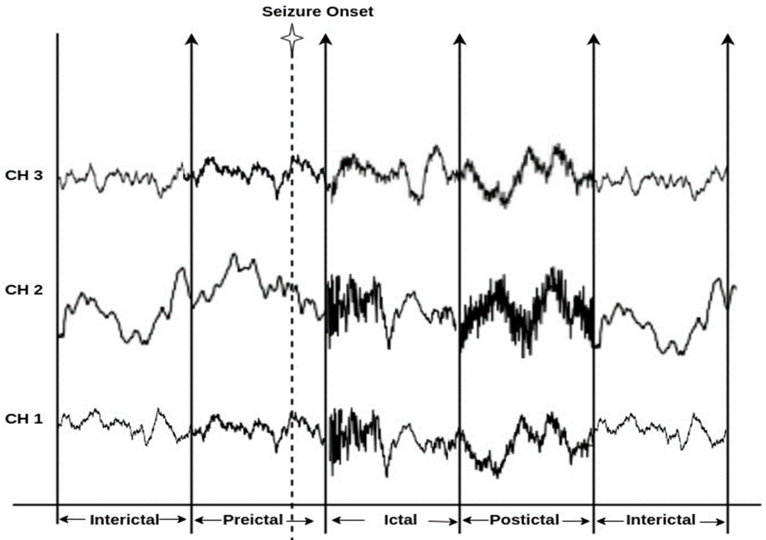 Sensors | Free Full-Text | Patient-Specific Preictal Pattern-Aware Epileptic Seizure Prediction ...