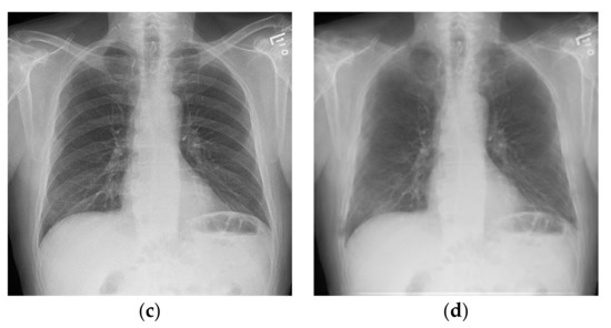 Development of Debiasing Technique for Lung Nodule Chest X-ray Datasets to Generalize Deep ...