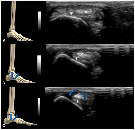 Hearing and Seeing Nerve/Tendon Snapping: A Systematic Review on ...