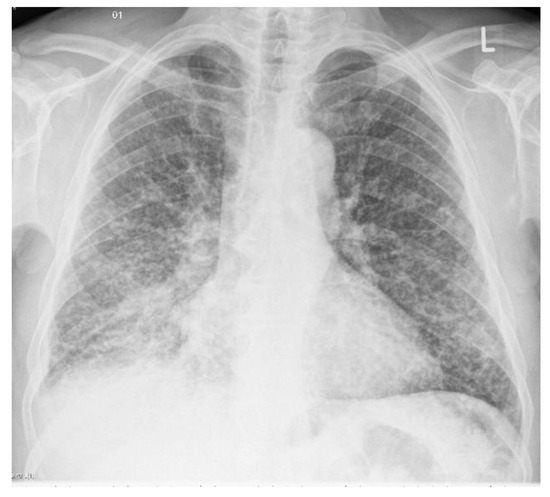 Pulmonary Tuberculosis Xray Thoracic Balls | CMAJ