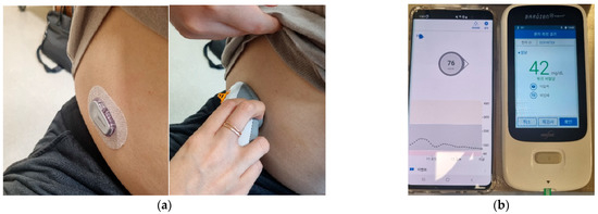 Continuous Glucose Monitoring: A Possible Aid for Detecting ...