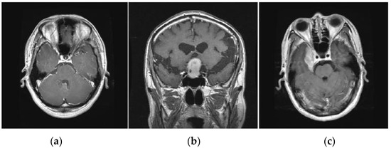 An Augmented Modulated Deep Learning Based Intelligent Predictive Model for Brain Tumor ...