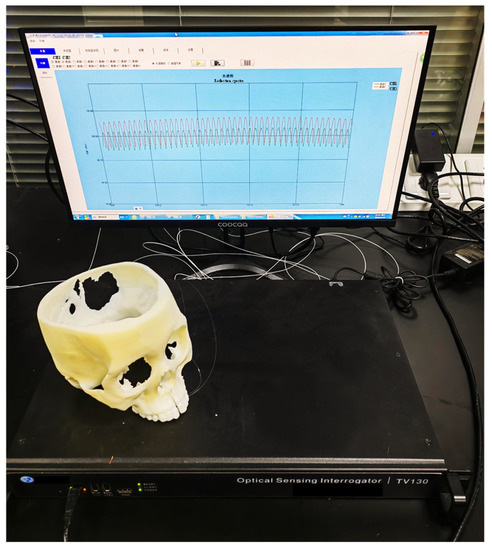 Monitoring the Opening of Rapid Palatal Expansion (RPE) in a 3D-Printed ...