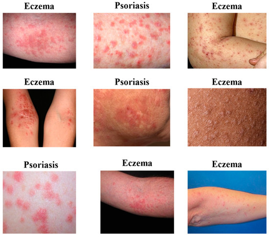 Sensors Free Full Text Enhanced Deep Learning Approach For Accurate Eczema And Psoriasis
