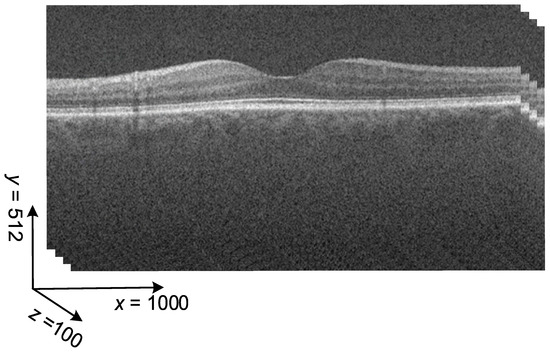 Automated Age-Related Macular Degeneration Detector on Optical ...