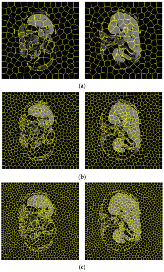 Sensors | Free Full-Text | Automatic Liver Tumor Segmentation from CT Images Using Graph ...